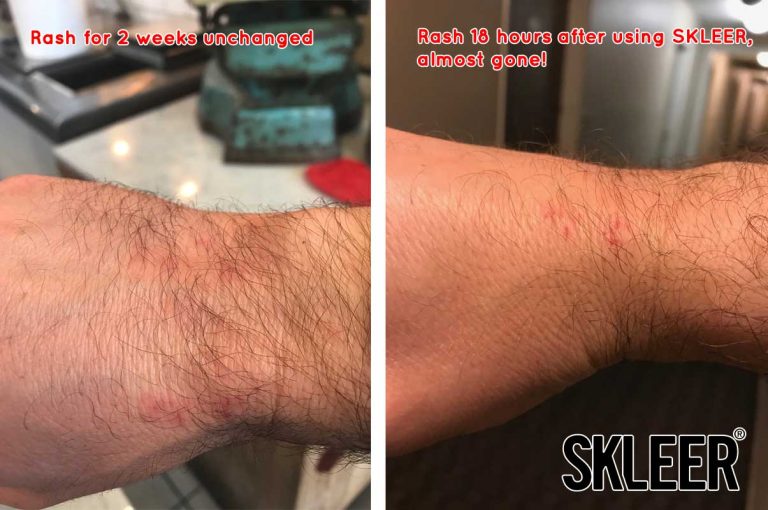 Dermatitis & Eczema - SKLEER Natural Skin Restoration Gel