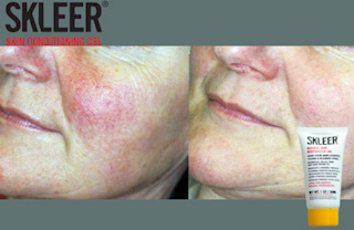 Rosacea or Redness Relief - SKLEER Natural Skin Restoration Gel