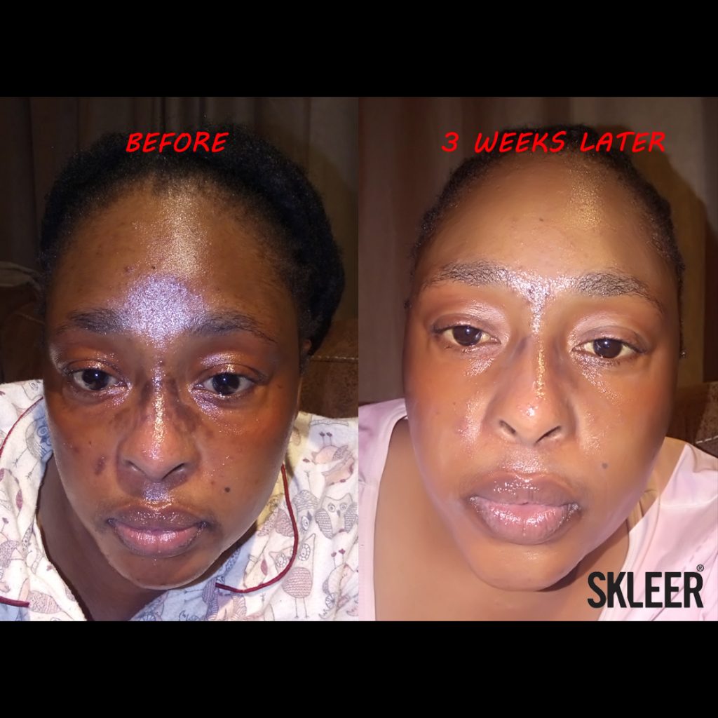 The natural way to Skin Confidence with Any Skin Type - SKLEER